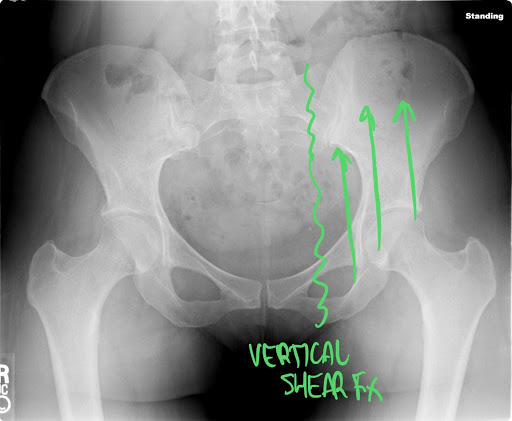 Radiology: Pelvic XR & Fractures – Rush Emergency Medicine
